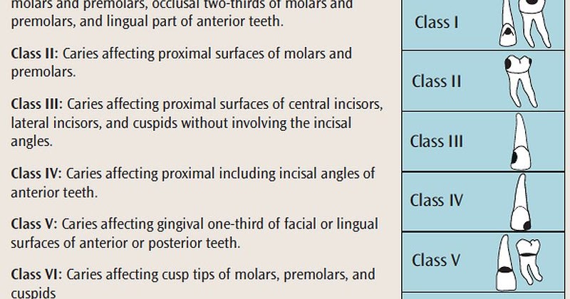 PDF: Dental Caries definition, classification and etiology - Ovi Dental