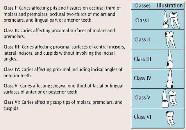 PDF: Dental Caries definition, classification and etiology