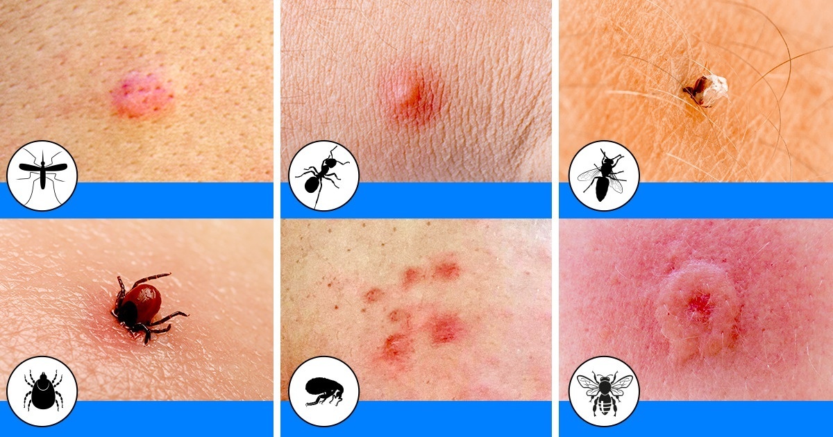 HOW TO RECOGNIZE AND TREAT THE 15 MOST COMMON BUG BITES