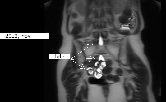 hourglass gallbladder