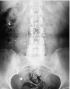 PROTOCOLO DE ESTUDIOS ESPECIALES: TRÁNSITO INTESTINAL
