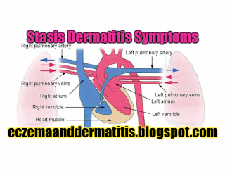 Stasis Dermatitis Symptoms - Eczema and Dermatitis
