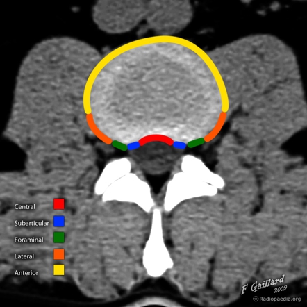 X-RAYview: HÉRNIA DISCAL - Classificação