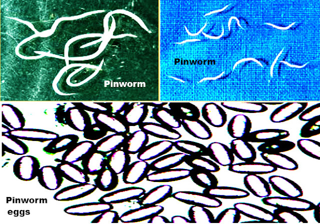 Pinworm Infections: Signs and symptoms, Causes, Diagnosis and Treatment.