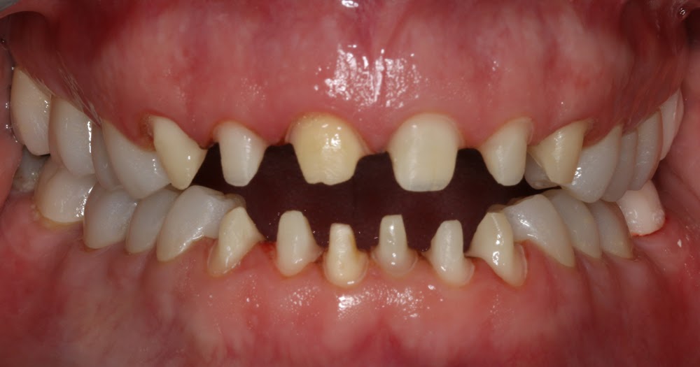 Will I Go Home With A Short, Ugly Tooth? ~ Dr. Bharat Katarmal Dental ...