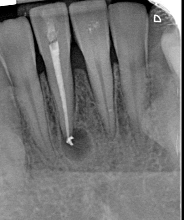 Caso clínico Máster: Necropulpectomía 41 calcificado