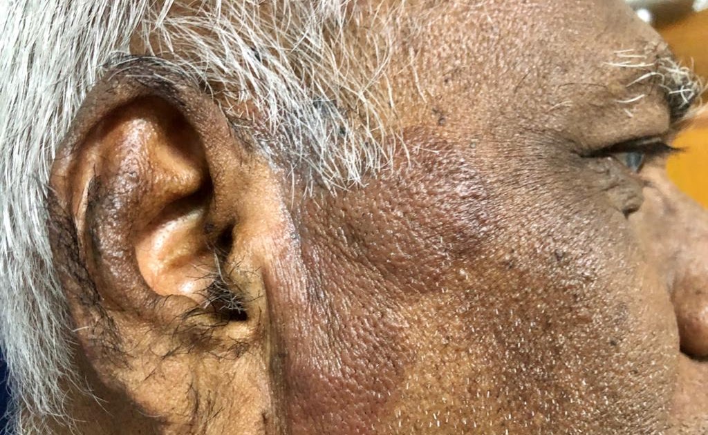 VIRTUAL GRAND ROUNDS IN DERMATOLOGY 2.0: 70 y.o. man with pre-auricular ...