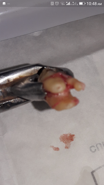 Dentosphere : World of Dentistry: Radix Entomolaris / Radix Paramolaris