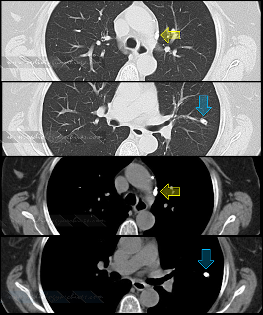 Radiology Archives: Πρωτοπαθές Σύμπλεγμα Φυματίωσης (Σύμπλεγμα Ranke)