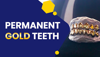 Harris Park Dental Lab in Australia: Permanent Gold Teeth Cost ...