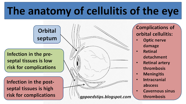 Paediatrics for Primary Care (and anyone else): Periorbital cellulitis ...