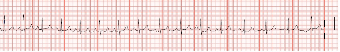 EKG Rhythm Strips: Hyperkalemia part 1