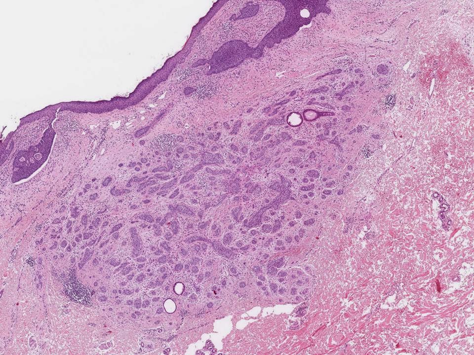 Differential Diagnosis in Dermatopathology: Desmoplasia