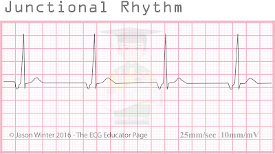 ECG Educator Blog : Junctional Rhythms