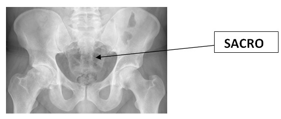 Columna Vertebral: REGIÓN SACROCCOCÍGEA
