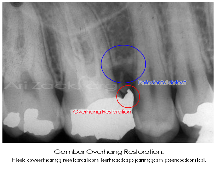 Sudah Idealkah Tambalan Gigimu ?? Kenali dan Periksa Tambalan Gigimu ...