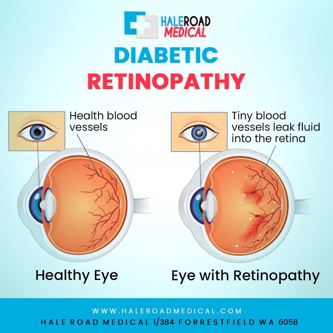 Diabetic Retinopathy Classification