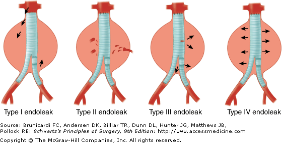 淨元法師之大醫院小醫師: 內滲漏 : endoleaks