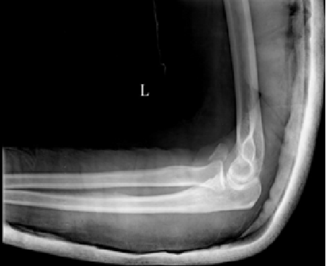 Coronoid Process Fracture - Case Presentation