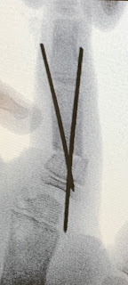 Cleft Hand: Beyond the Basics | Congenital Hand and Arm Differences ...