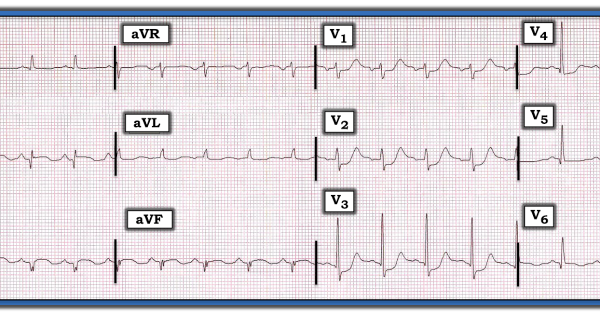 ECG Interpretation: ECG Blog #246 (60) — What is the Mirror Test?
