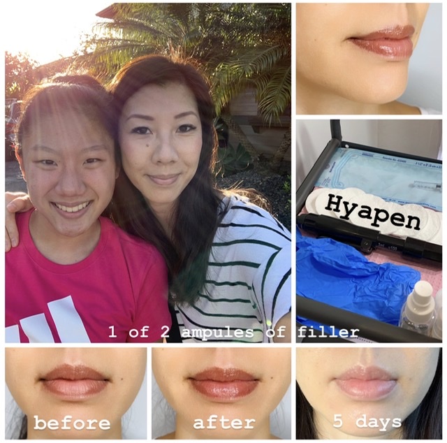 Hawaii Mom Blog: New Hyapen Lip Enhancement Service at Kristin Wood