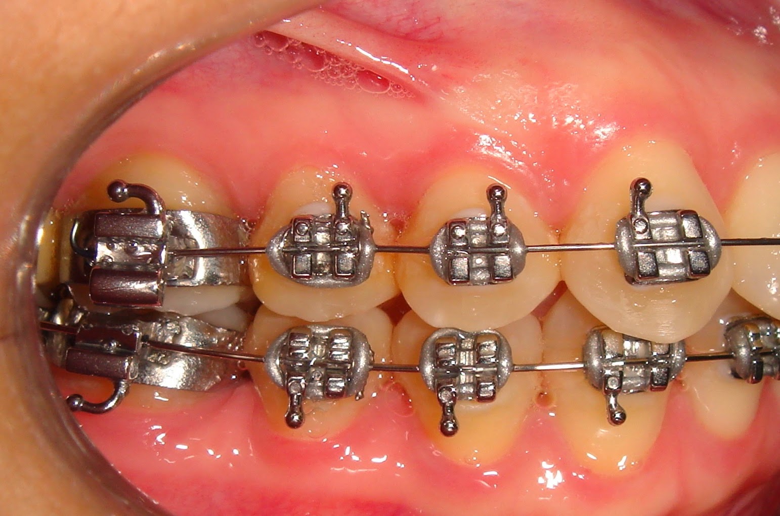 Oh No! My Bracket fell off! | Orthodontics in London