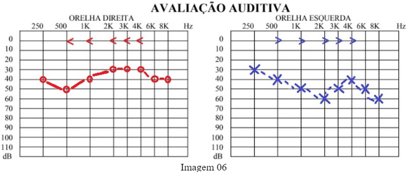 Audiometria Tonal Liminar