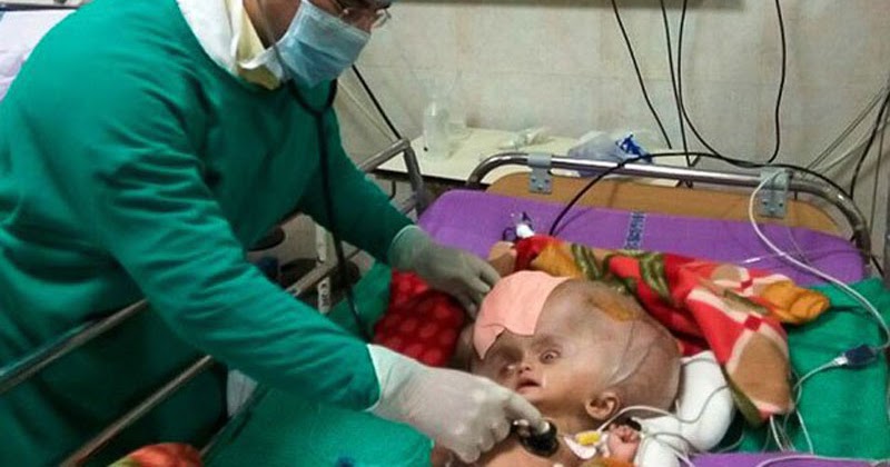 Boy with ‘world’s largest head’ undergoes surgery - Dhoom