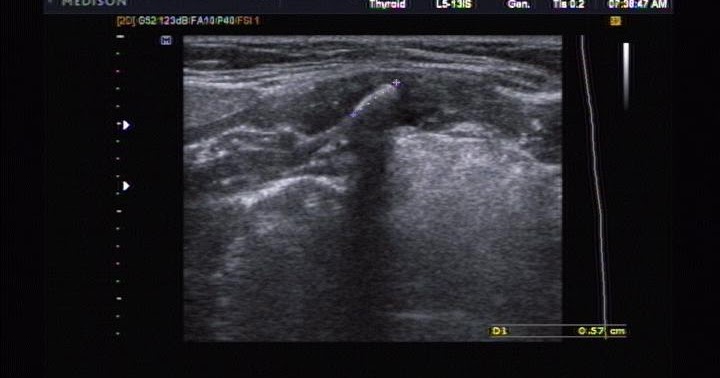 VIETNAMESE MEDIC ULTRASOUND: CASE 127: ELONGATED STYLOID PROCESS, Dr ...