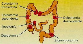 Enfermería Médico Quirúrgica 1. GRUPO 12: PRÁCTICA IV. OSTOMÍAS