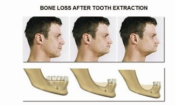 Facial Development Newsletter: Enhanced Bone Health in Conjunction with ...