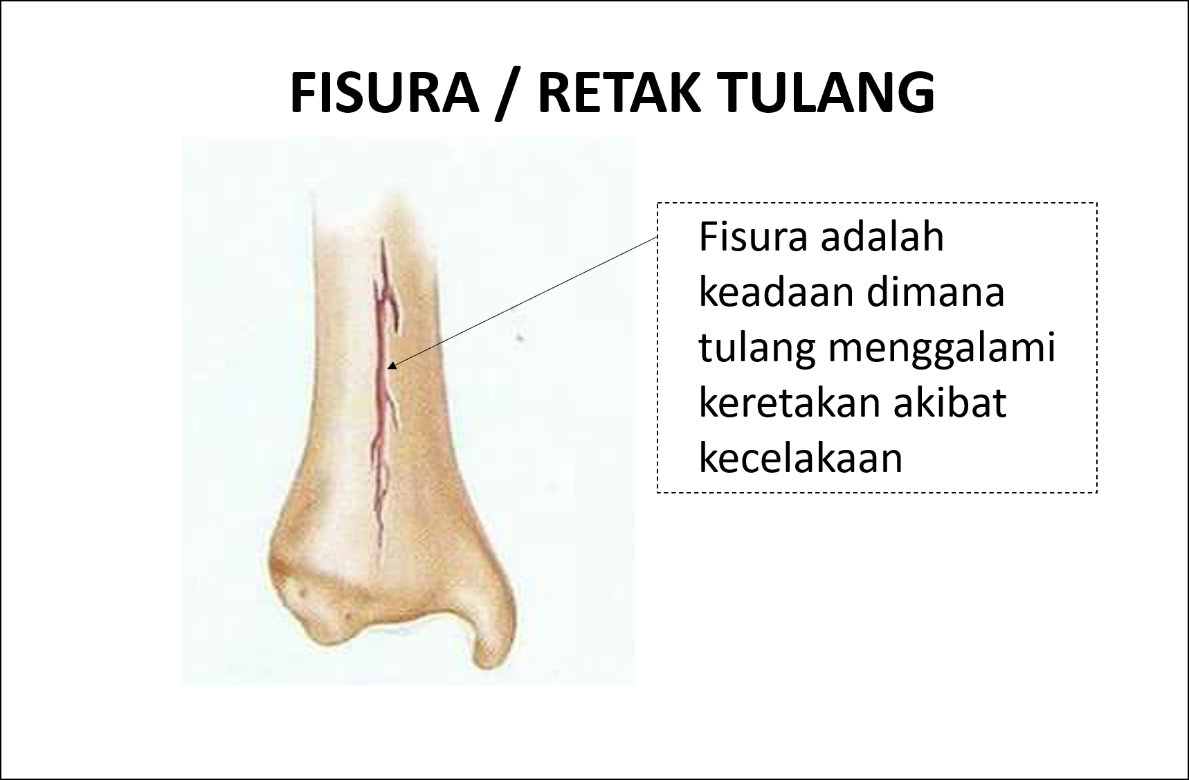 Macam Kelainan pada Tulang ~ Kelas Bu Asih