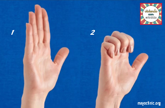 Viviendo con artritis: Ejercicios de terapia ocupacional (mano-garra)