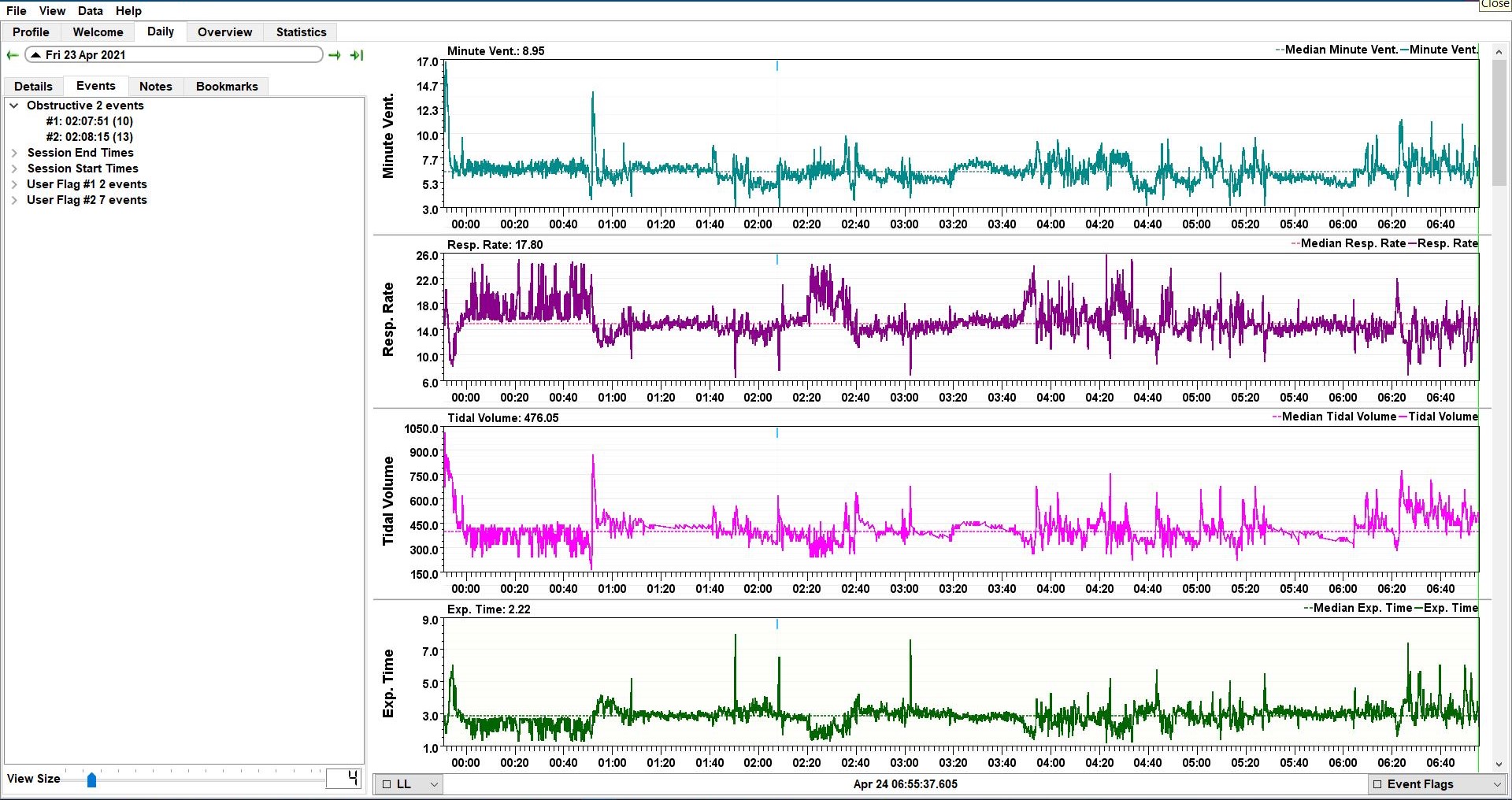 CPAP Health Issues: What BiPAP Settings prevent Alzheimer's due to REM ...
