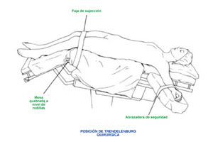 POSICIONES QUIRURGICAS: POSICIÓN TRENDELENBURG
