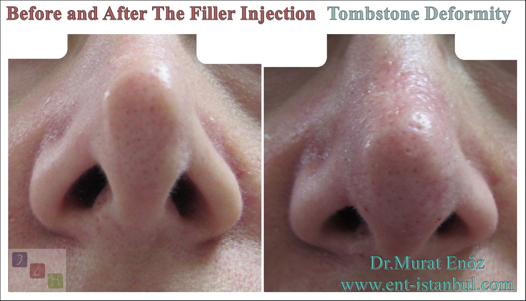 Filler Injection For "Visible Shield Graft Edges - Tombstone Deformity"