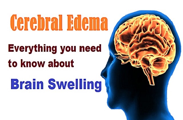 Cerebral Edema (Brain Swelling) - Types, Symptoms, Causes and Treatment