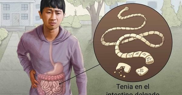 TAENIA SOLIUM: SINTOMATOLOGÍA TENIASIS.