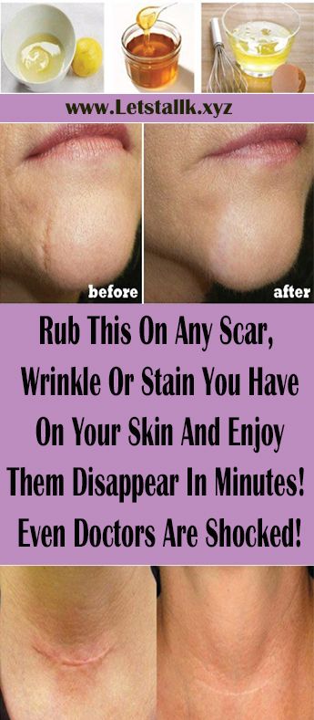 Rub This On Any Scar, Wrinkle Or Stain You Have On Your Skin And Enjoy ...