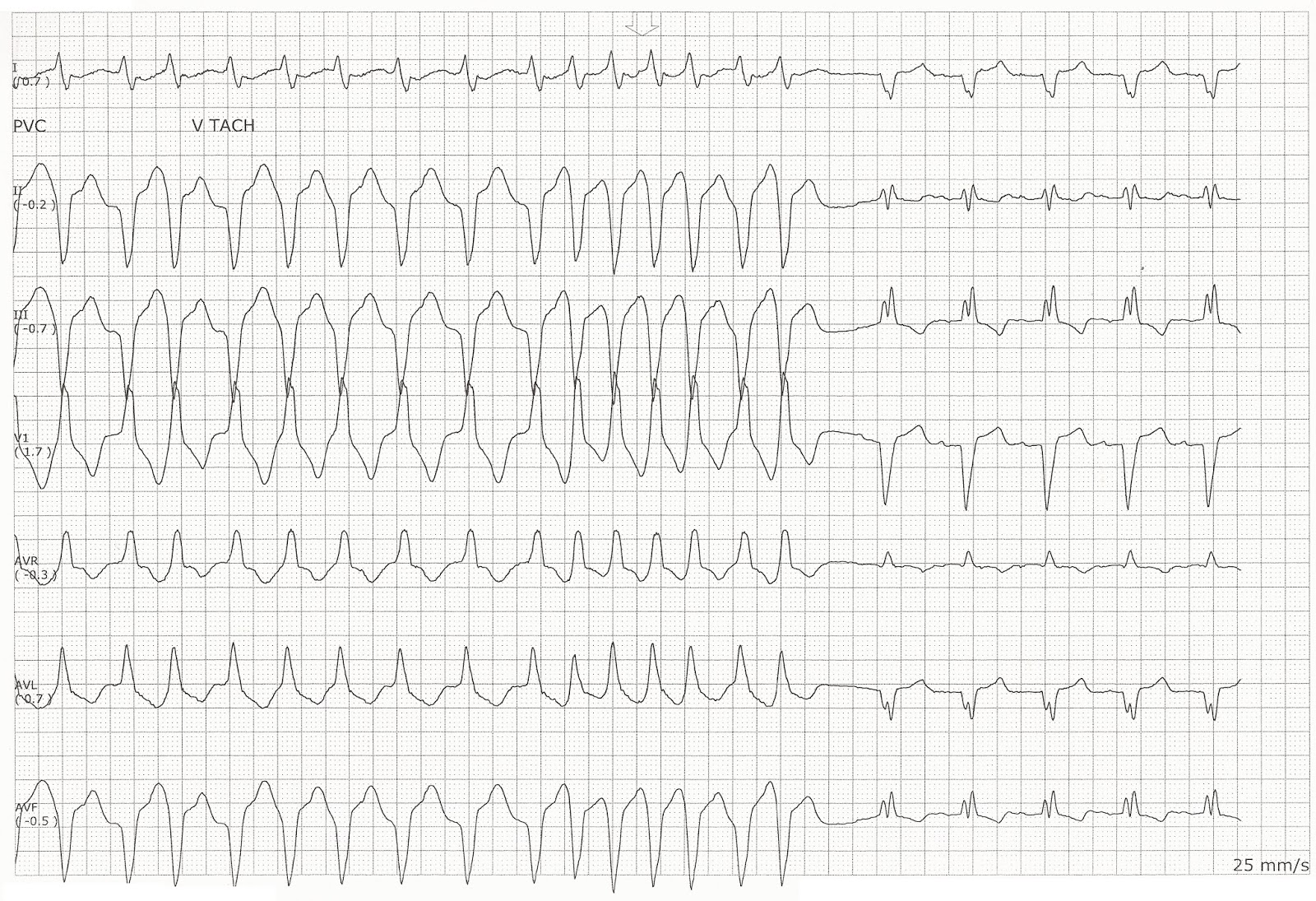 Sinus Rhythm with a Run of Ventricular Tachycardia