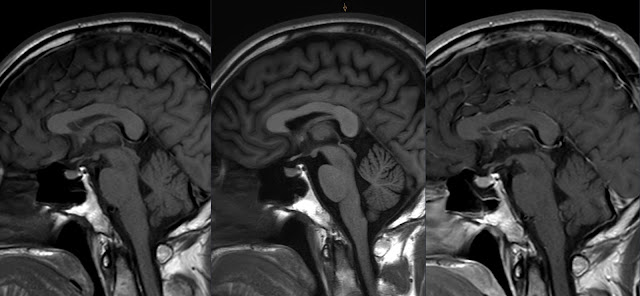 Cytotoxic Lesions Of the Corpus Callosum (CLOCCs)