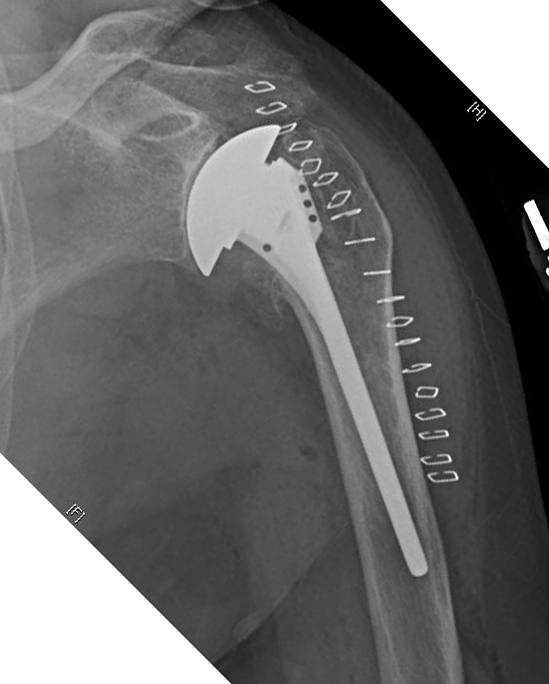 Shoulder Arthritis / Rotator Cuff Tears: causes of shoulder pain: Varus ...