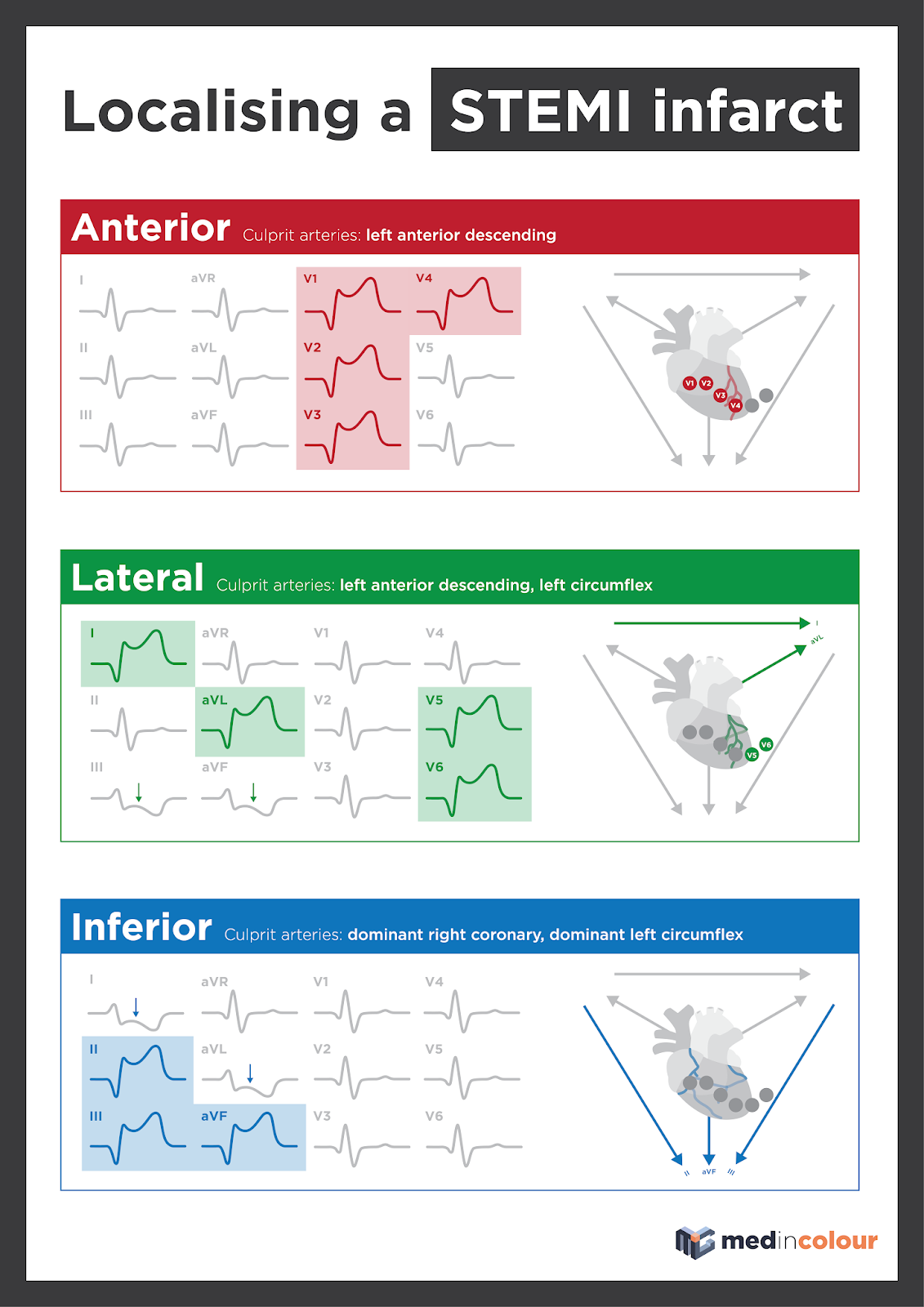 Localising a STEMI Infarction