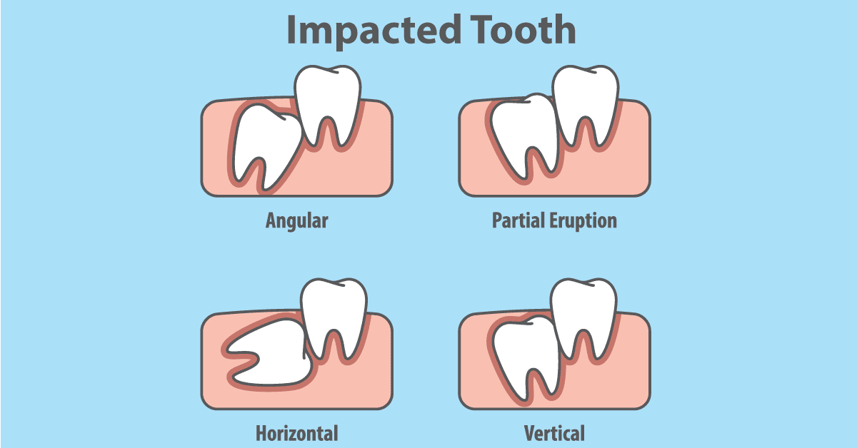 Surgical removal of impacted teeth (10)