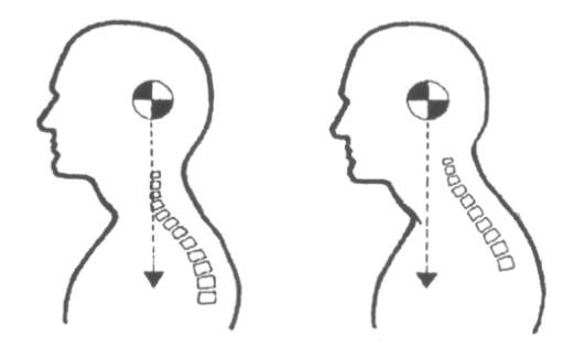 Fitness Integrity: Postural assessment (Forward Head Posture)