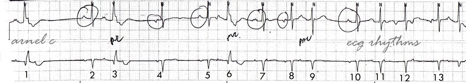Multifocal Atrial Tachycardia Ecg
