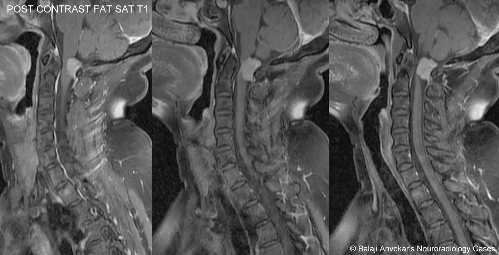 Dr Balaji Anvekar Frcr Cv Junction Meningioma Mri