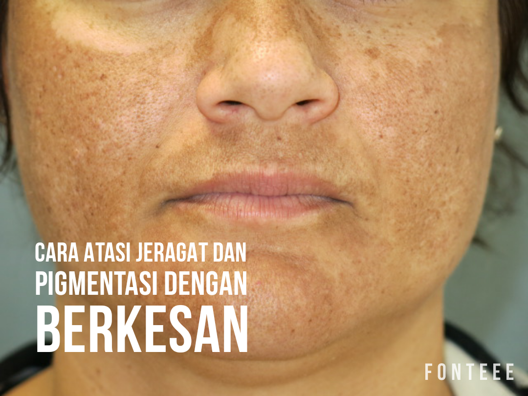 Cara Atasi Masalah Jeragat Dan Pigmentasi Dengan Berkesan - Sihat Itu Nikmat
