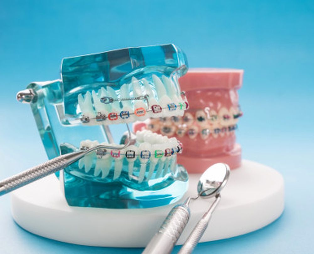 Retratamiento de Ortodoncia: ¿Cuándo es necesario? - OdontoVida
